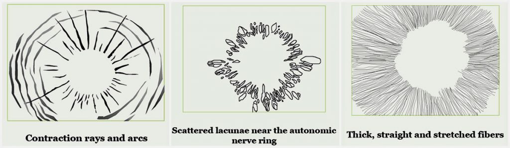 Iris Patterns - The Basics of Iridology