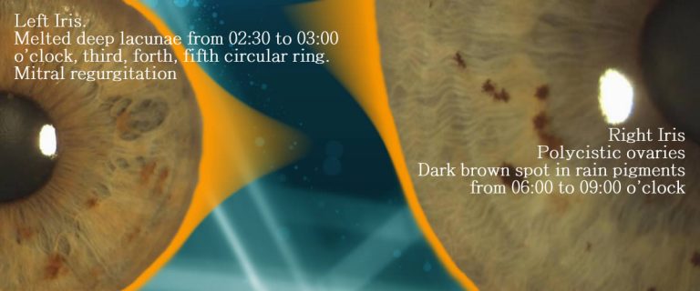 Iris Markings - The Basics of Iridology